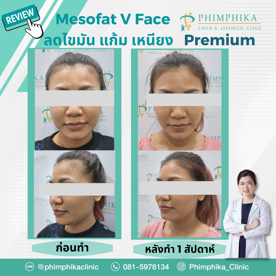 MESOFAT เมโสแฟต - Phimphika Clinic