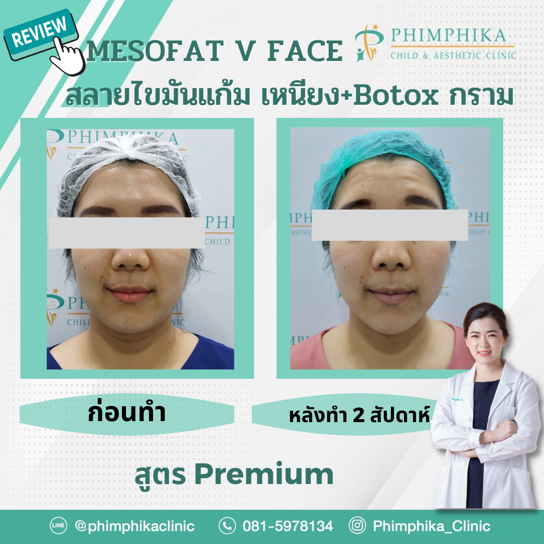 MESOFAT เมโสแฟต - Phimphika Clinic
