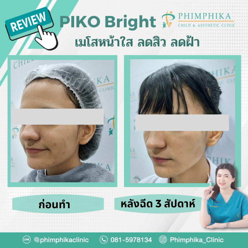 PIKO BRIGHT - Phimphika Clinic